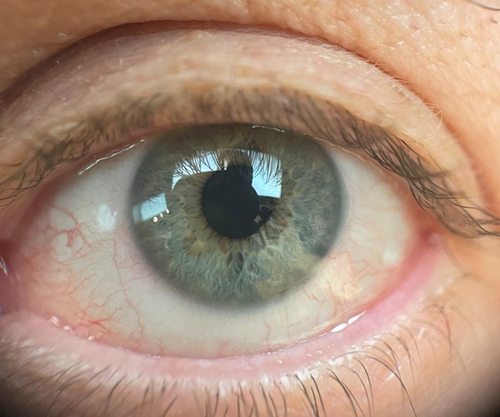 iTEAR®100 – Olympic Ophthalmics