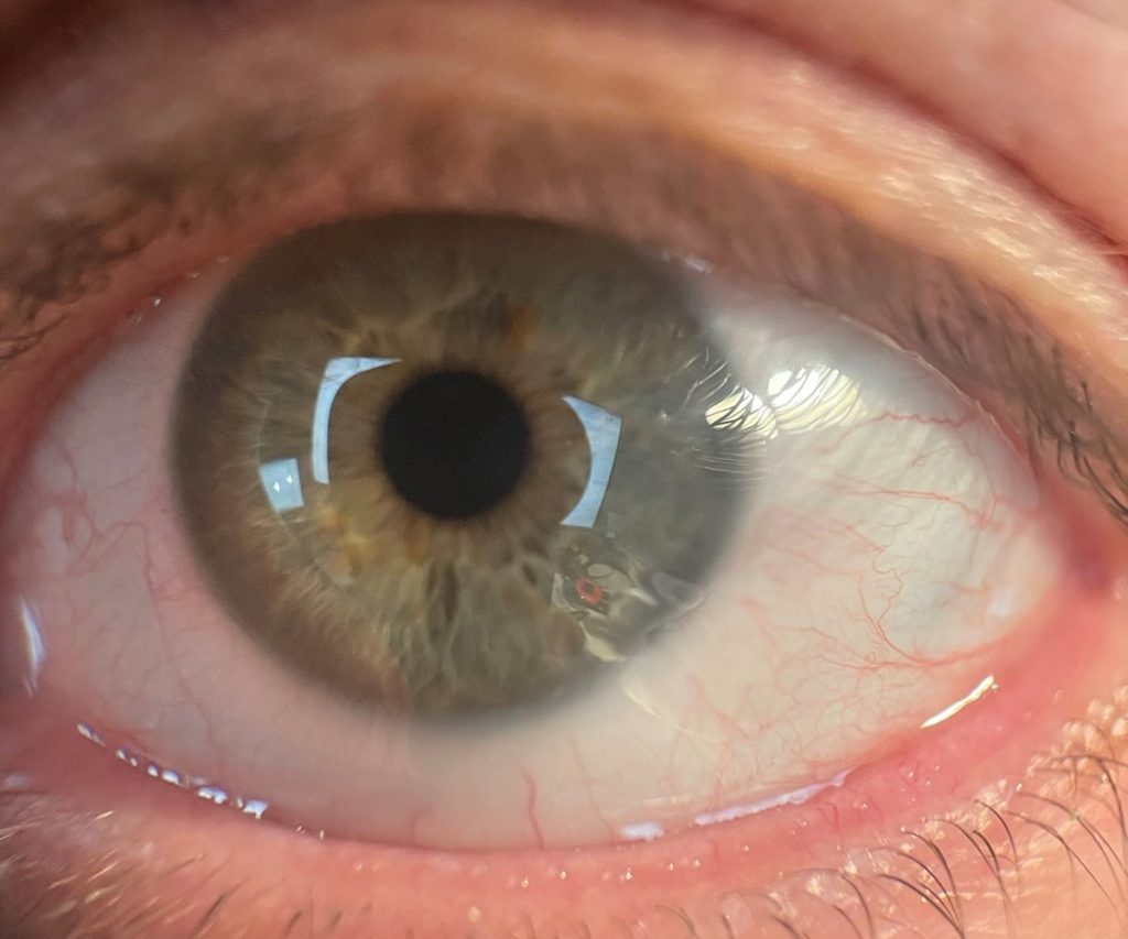 iTEAR®100 – Olympic Ophthalmics